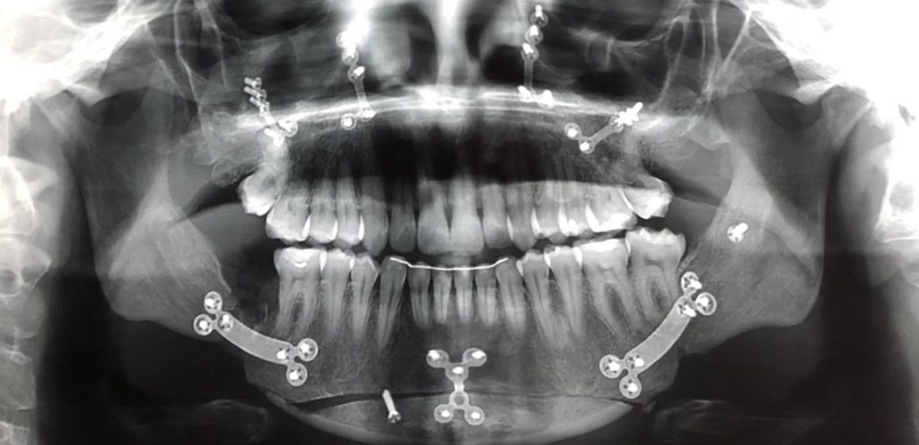 Chirurgia Maxillo-Facciale - Art medica